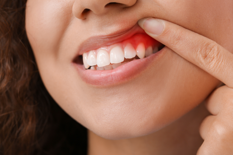 Why Are My Gums Soft and Spongy? | Pinnacle Dental